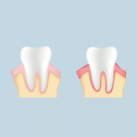 Gengive infiammate: rimedi e cause - DentalPro